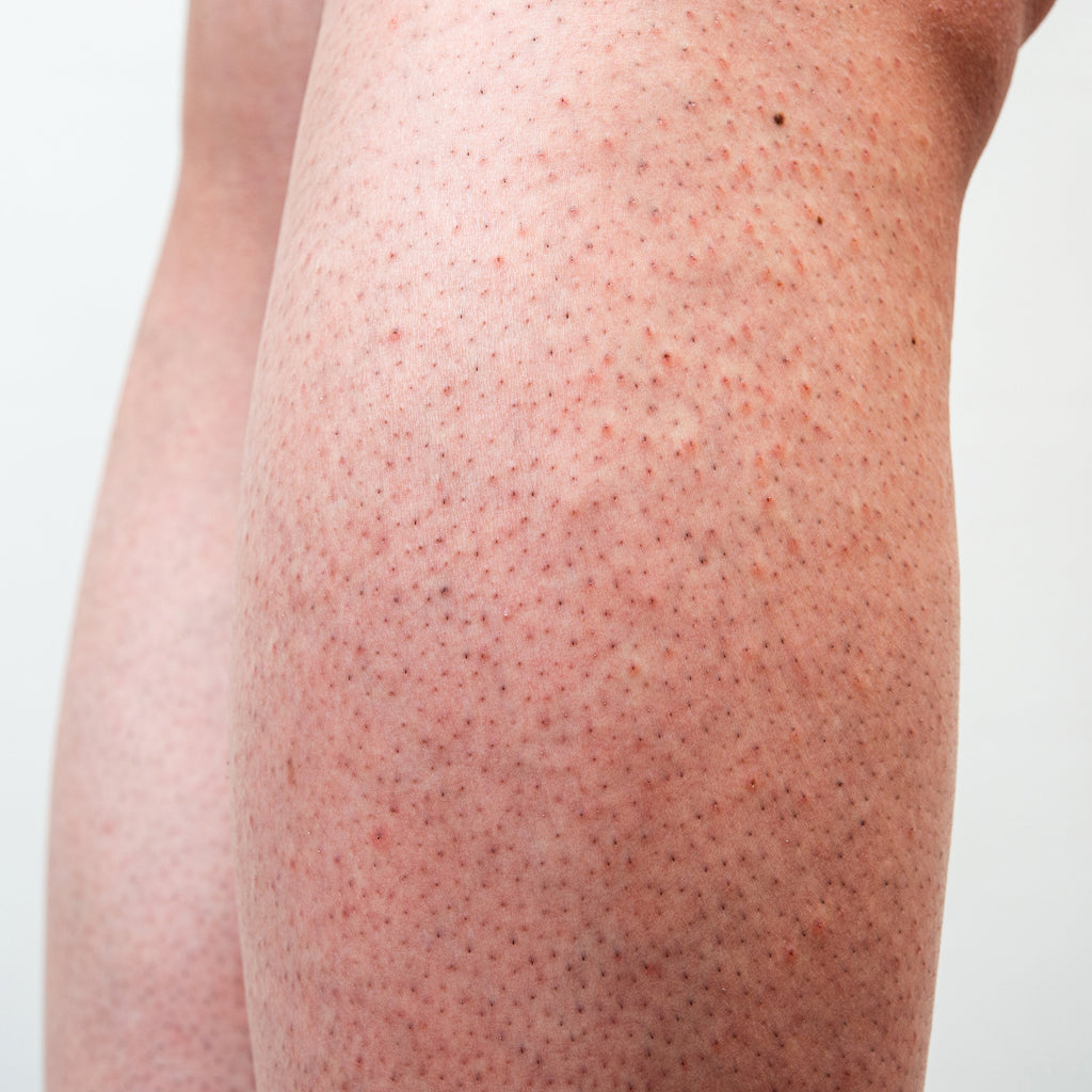 Dark Pores On Legs After Shaving